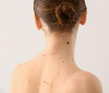 Moles Diagnosis and Treatment in West Bloomfield, Novi, Commerce ...